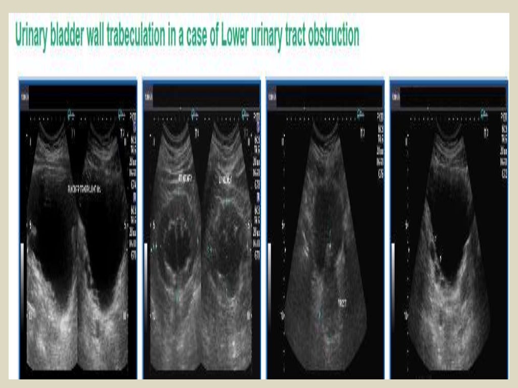 Presentation1.pptx, ultrasound examination of the urinary bladder and…