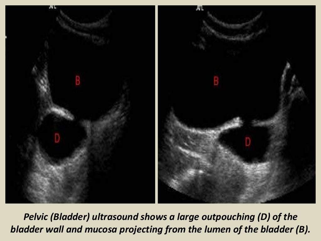 Presentation1.pptx, ultrasound examination of the urinary bladder and…