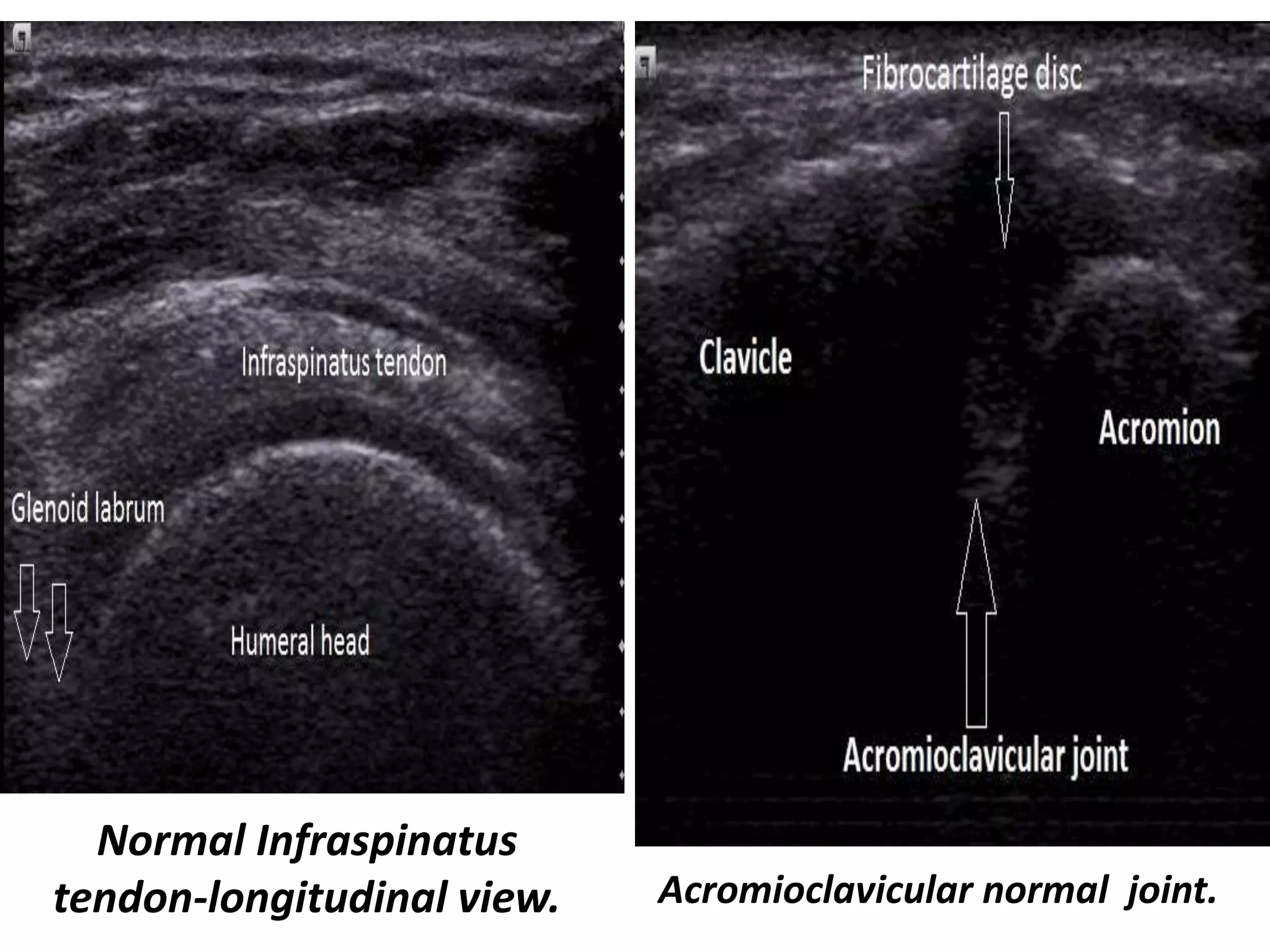Presentation1.pptx, ultrasound examination of the shoulder joint. | PPTX