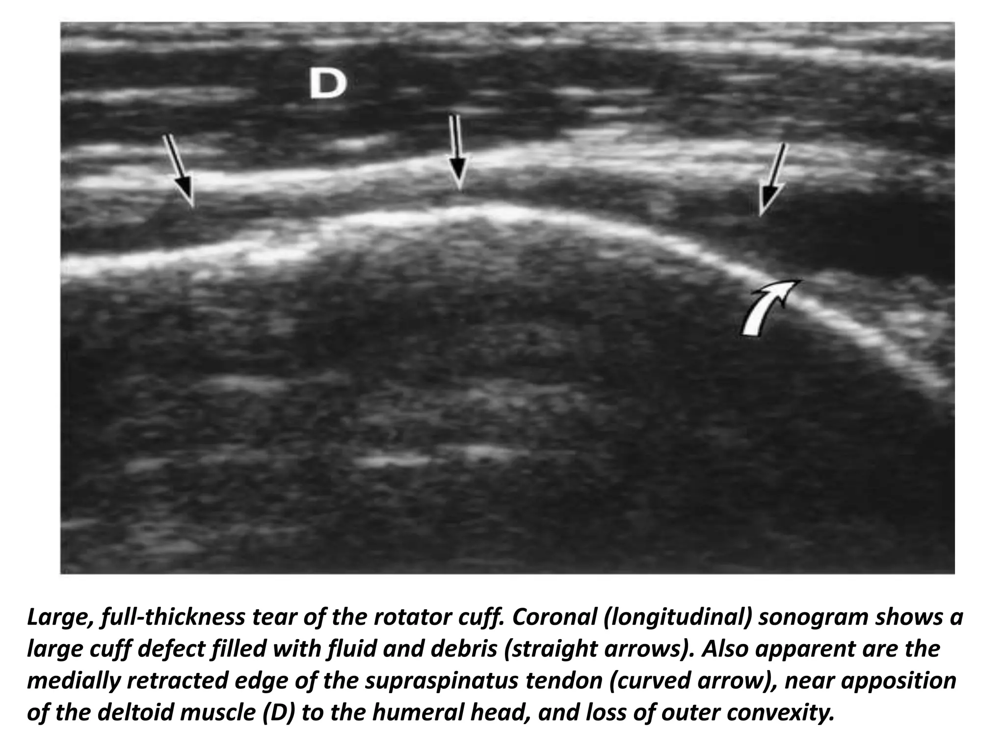 Presentation1.pptx, ultrasound examination of the shoulder joint. | PPTX