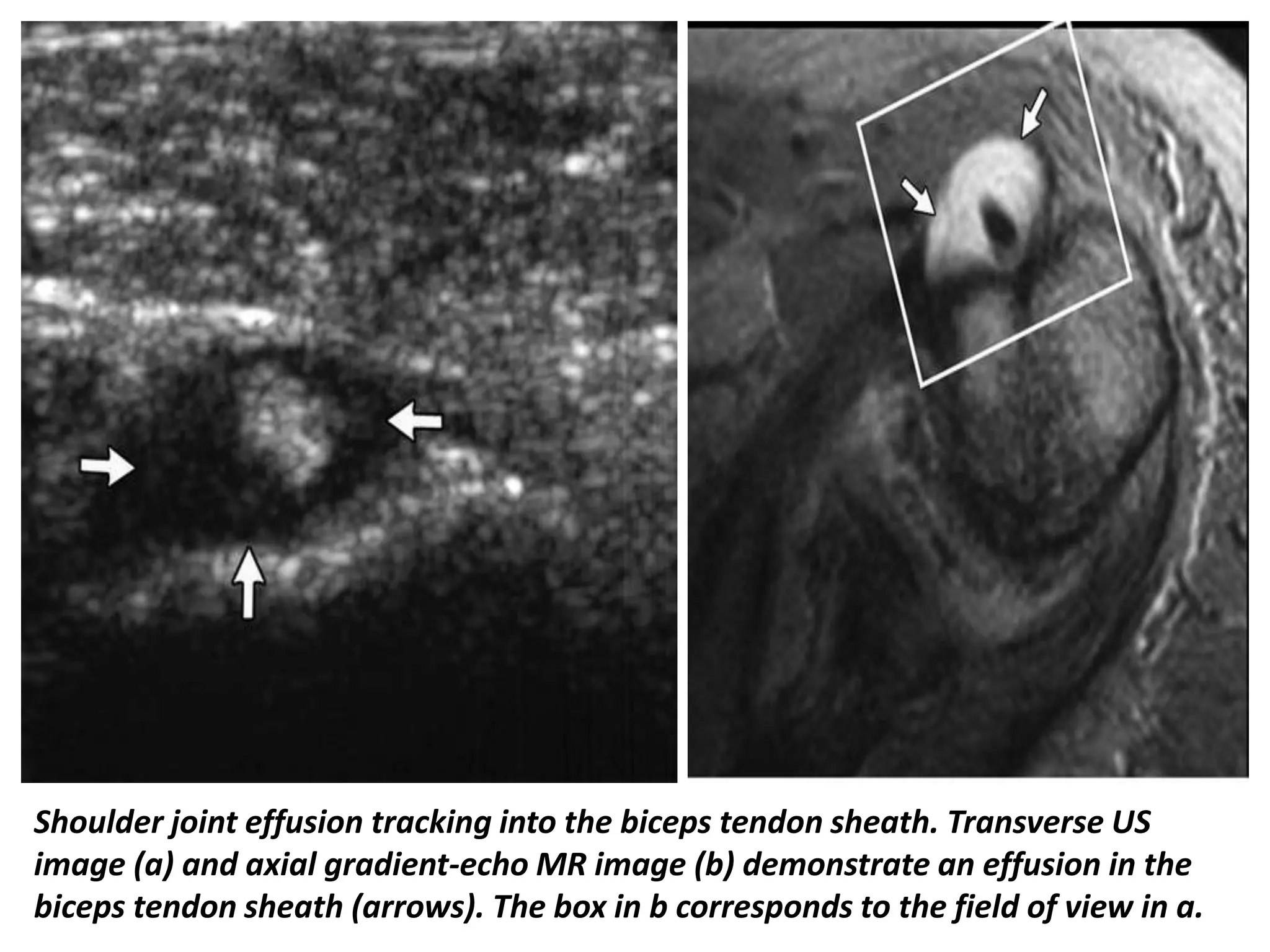 Presentation1.pptx, ultrasound examination of the shoulder joint. | PPTX