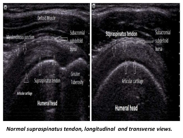 Presentation1.pptx, ultrasound examination of the shoulder joint.