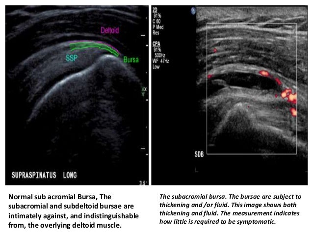 Presentation1pptx Ultrasound Examination Of The Shoulder Joint