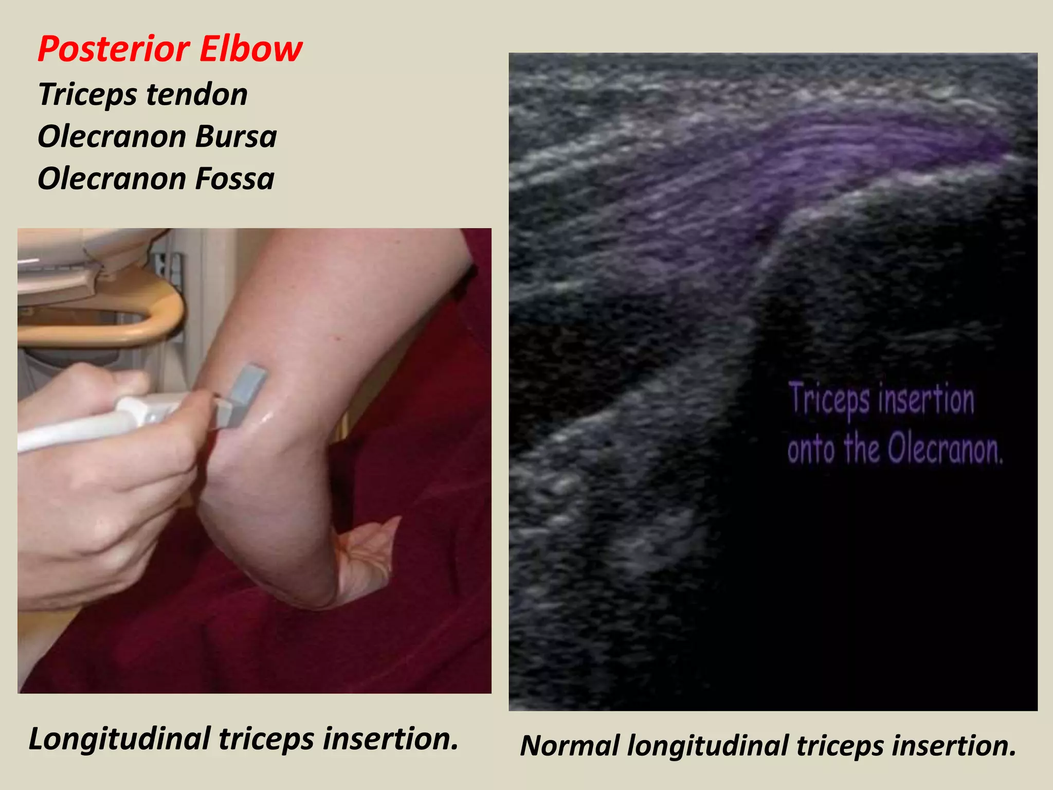 Presentation1.pptx, ultrasound examination of the elbow joint. | PPTX
