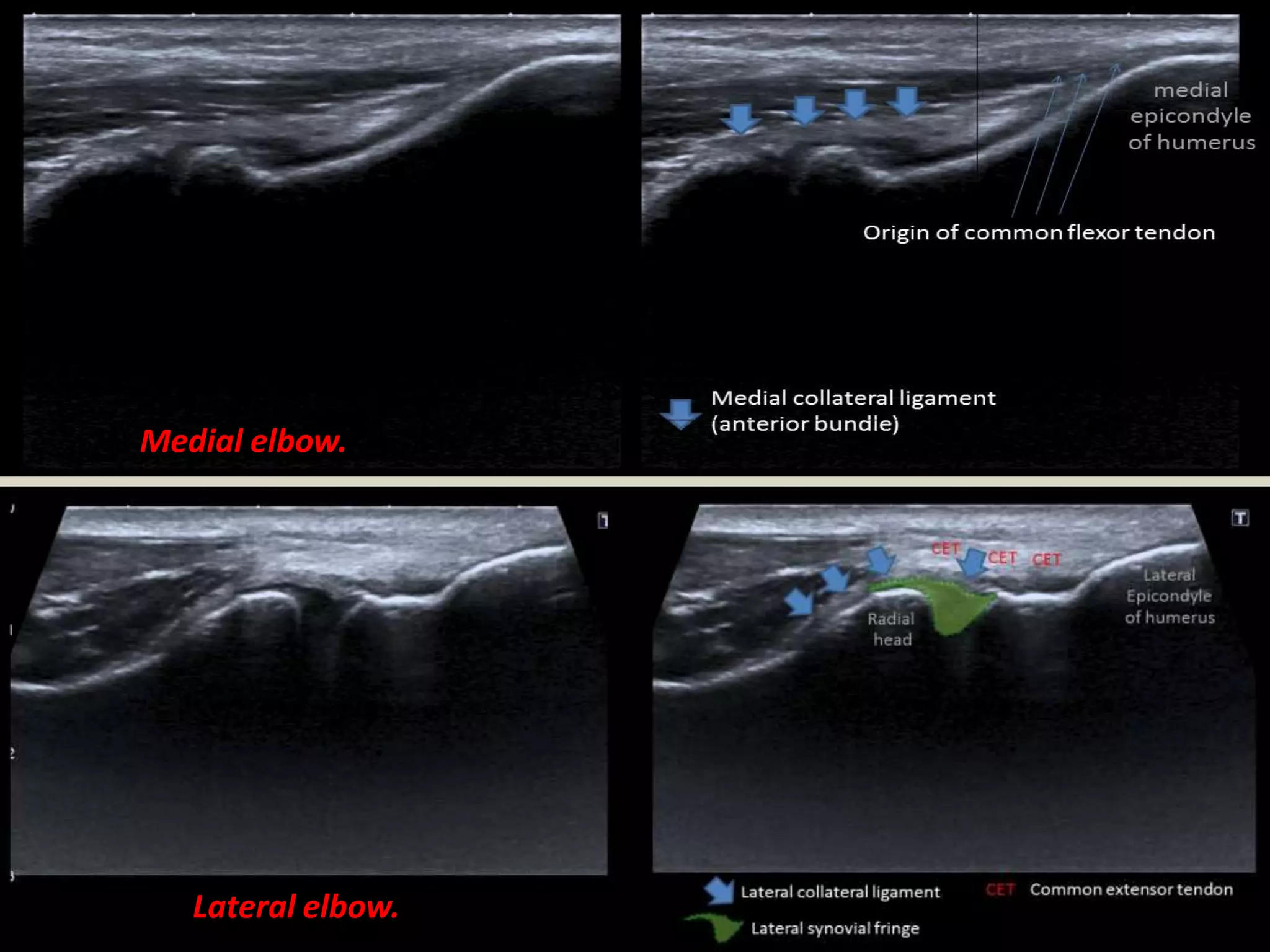 Presentation1.pptx, ultrasound examination of the elbow joint. | PPTX