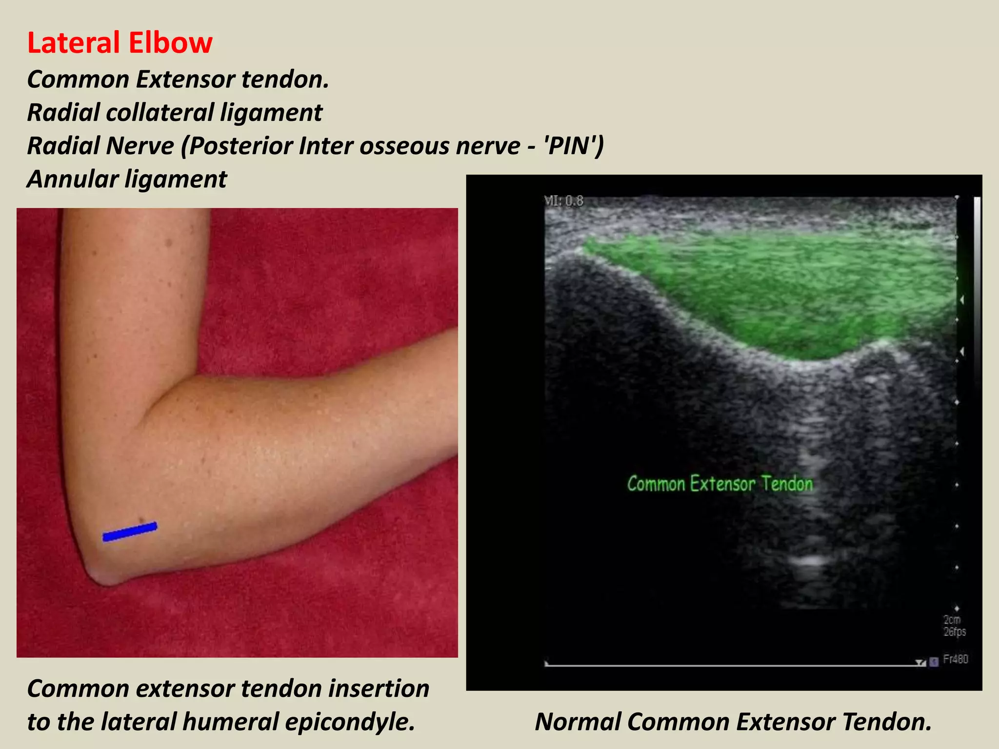Presentation1.pptx, ultrasound examination of the elbow joint. | PPTX