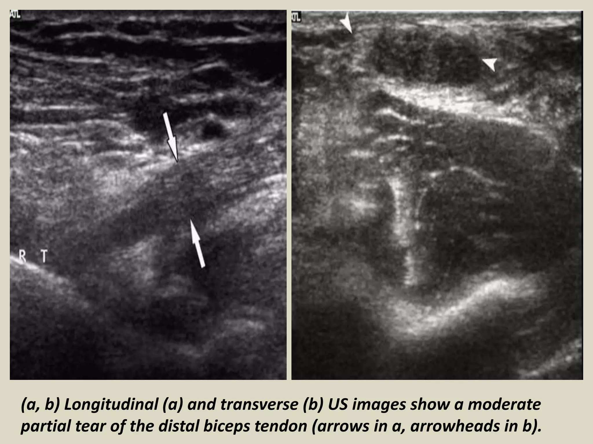 Presentation1.pptx, ultrasound examination of the elbow joint. | PPTX