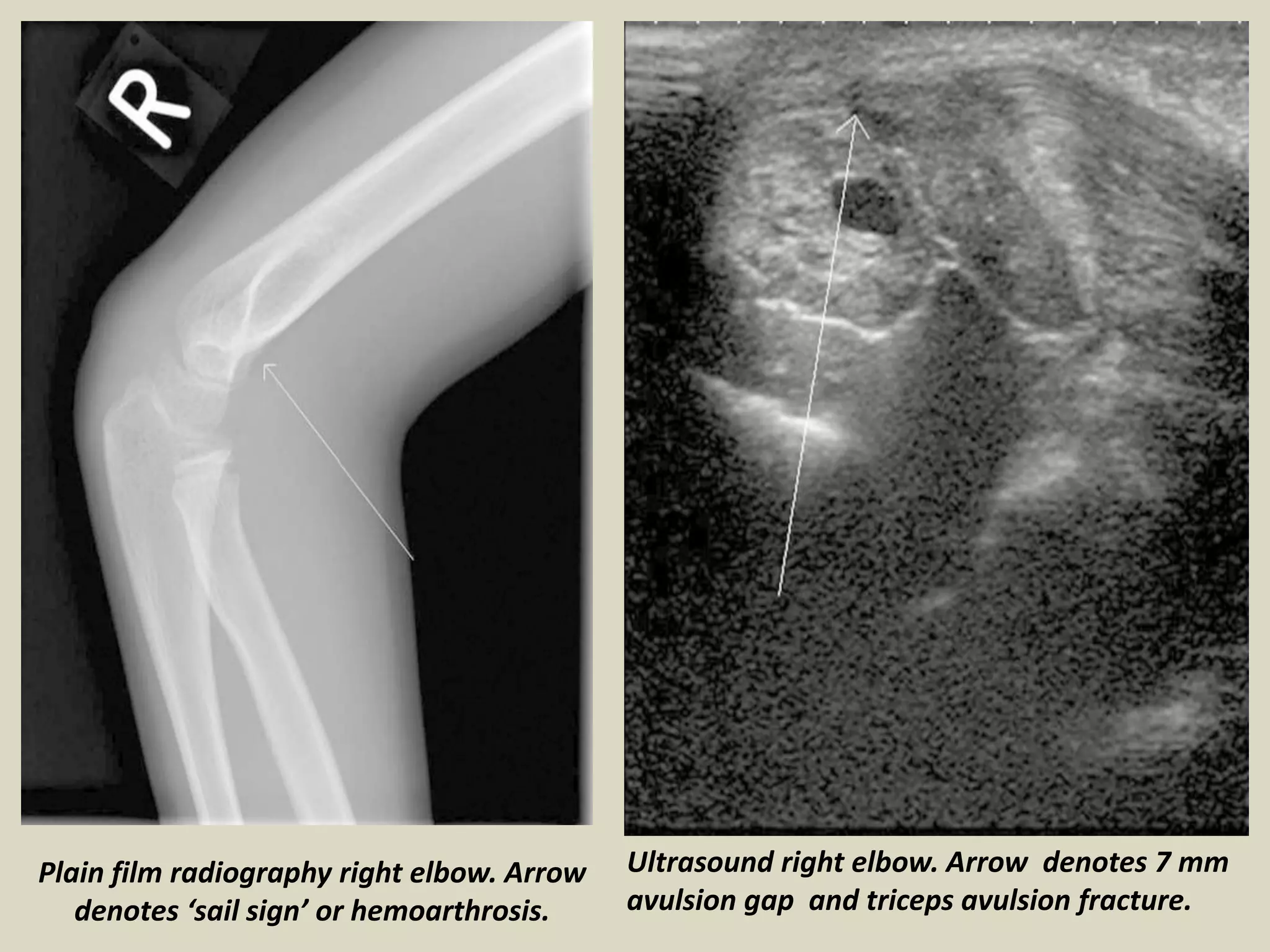Presentation1.pptx, ultrasound examination of the elbow joint. | PPTX