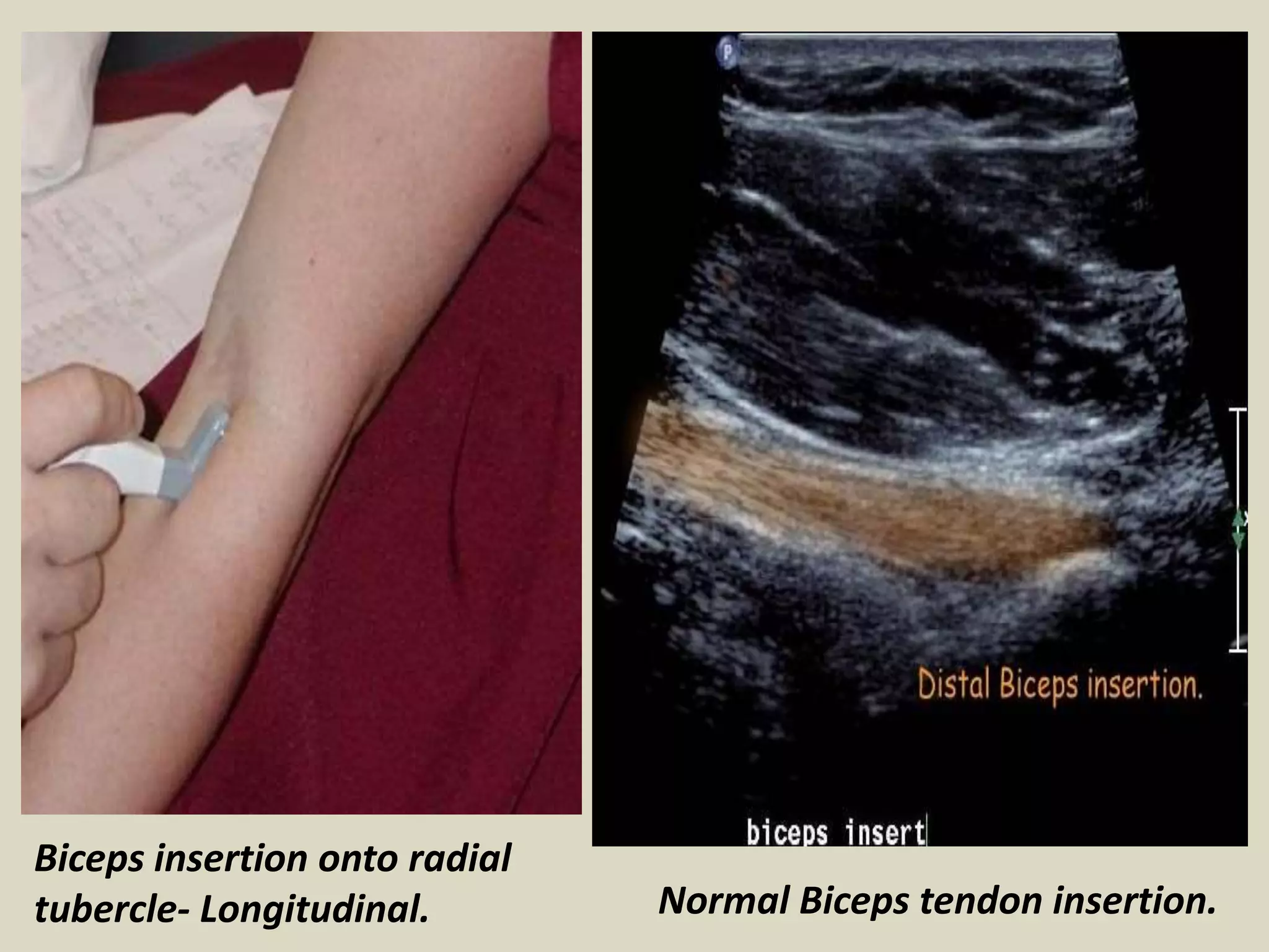 Presentation1.pptx, ultrasound examination of the elbow joint. | PPTX