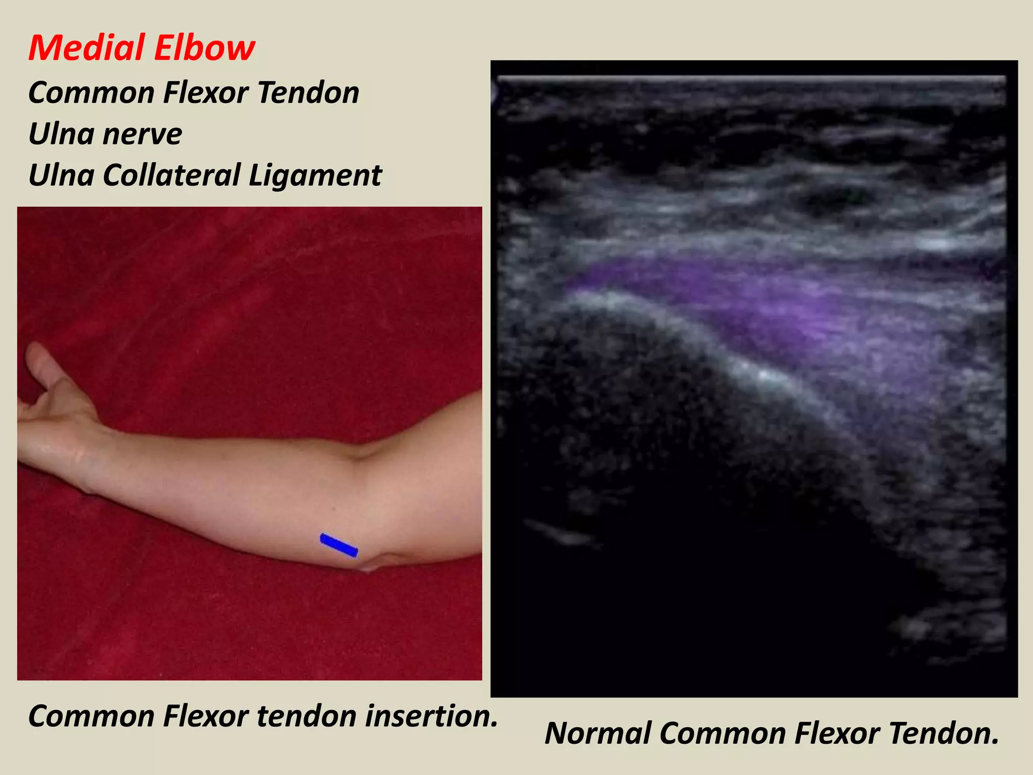 Presentation1.pptx, ultrasound examination of the elbow joint. | PPTX