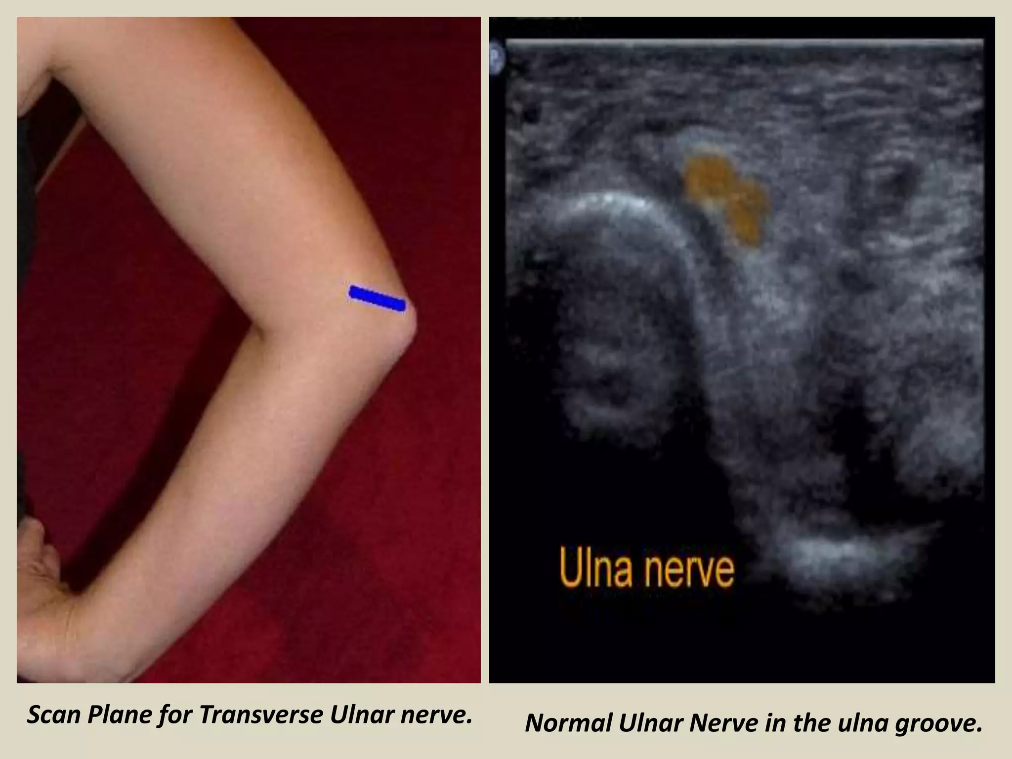 Presentation1.pptx, ultrasound examination of the elbow joint. | PPTX