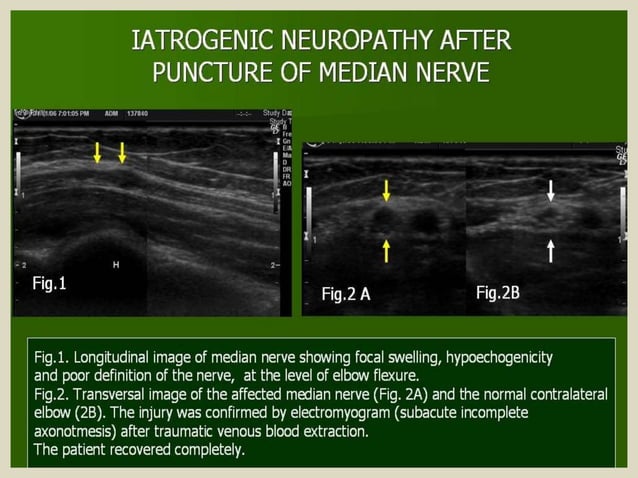 Presentation1pptx Ultrasound Examination Of The Elbow Joint Ppt