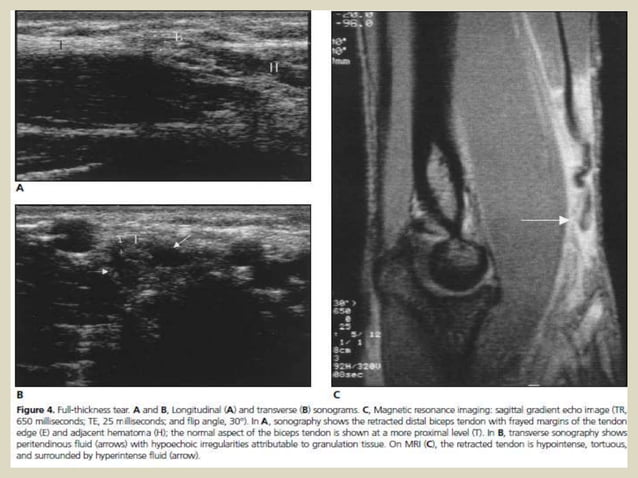 Presentation1.pptx, ultrasound examination of the elbow joint. | PPT