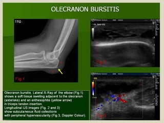 Olecranon Bursitis Xray