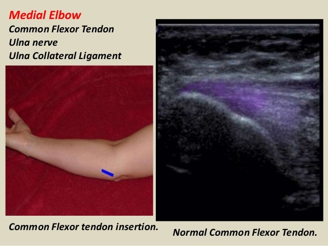 Common Flexor Tendon Elbow Ultrasound