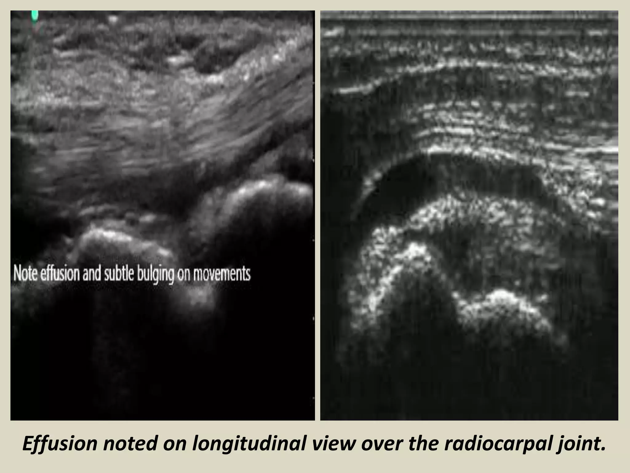 Presentation1.pptx, ultrasound examination of the wrist joint. | PPTX