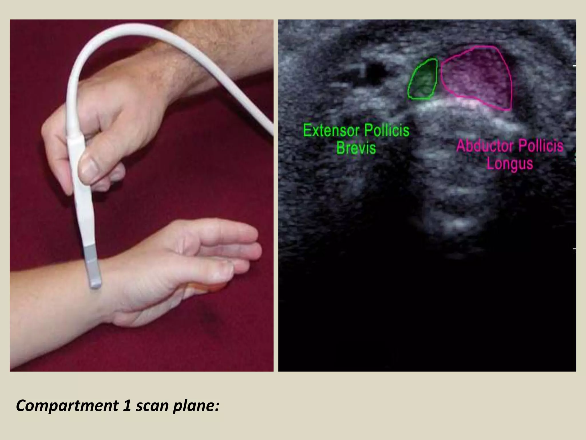 Presentation1.pptx, ultrasound examination of the wrist joint. | PPTX