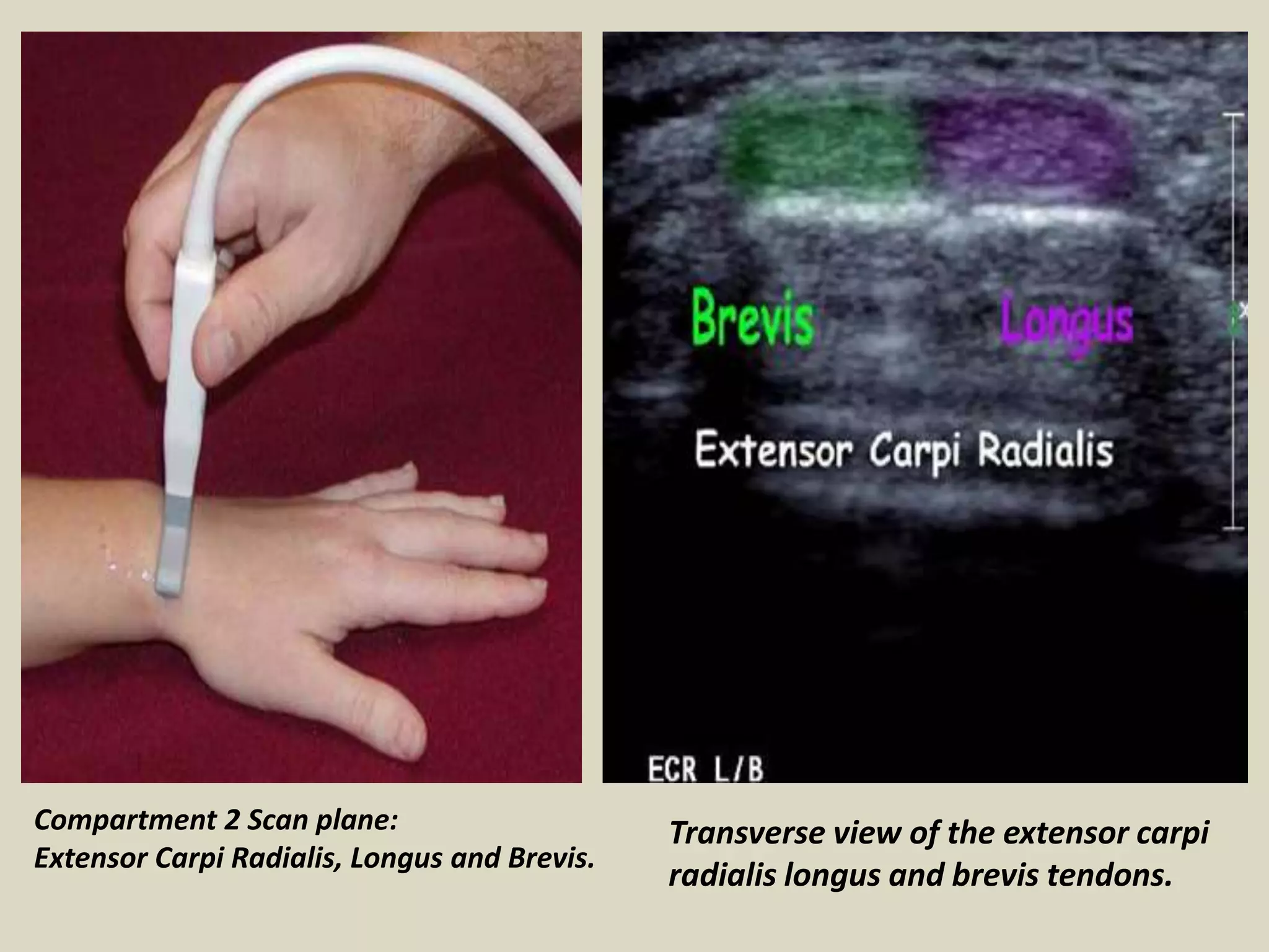 Presentation1.pptx, ultrasound examination of the wrist joint. | PPTX