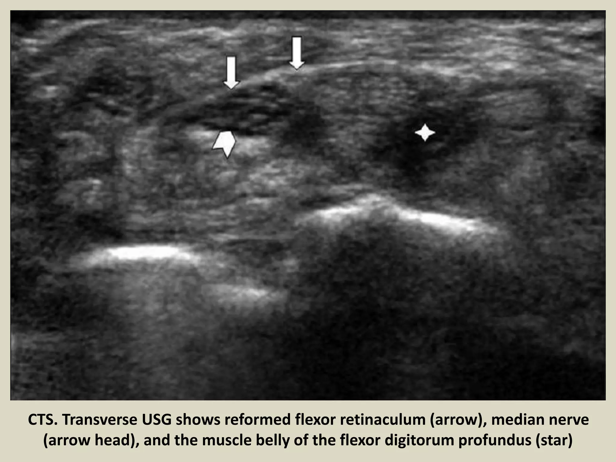Presentation1.pptx, ultrasound examination of the wrist joint. | PPTX