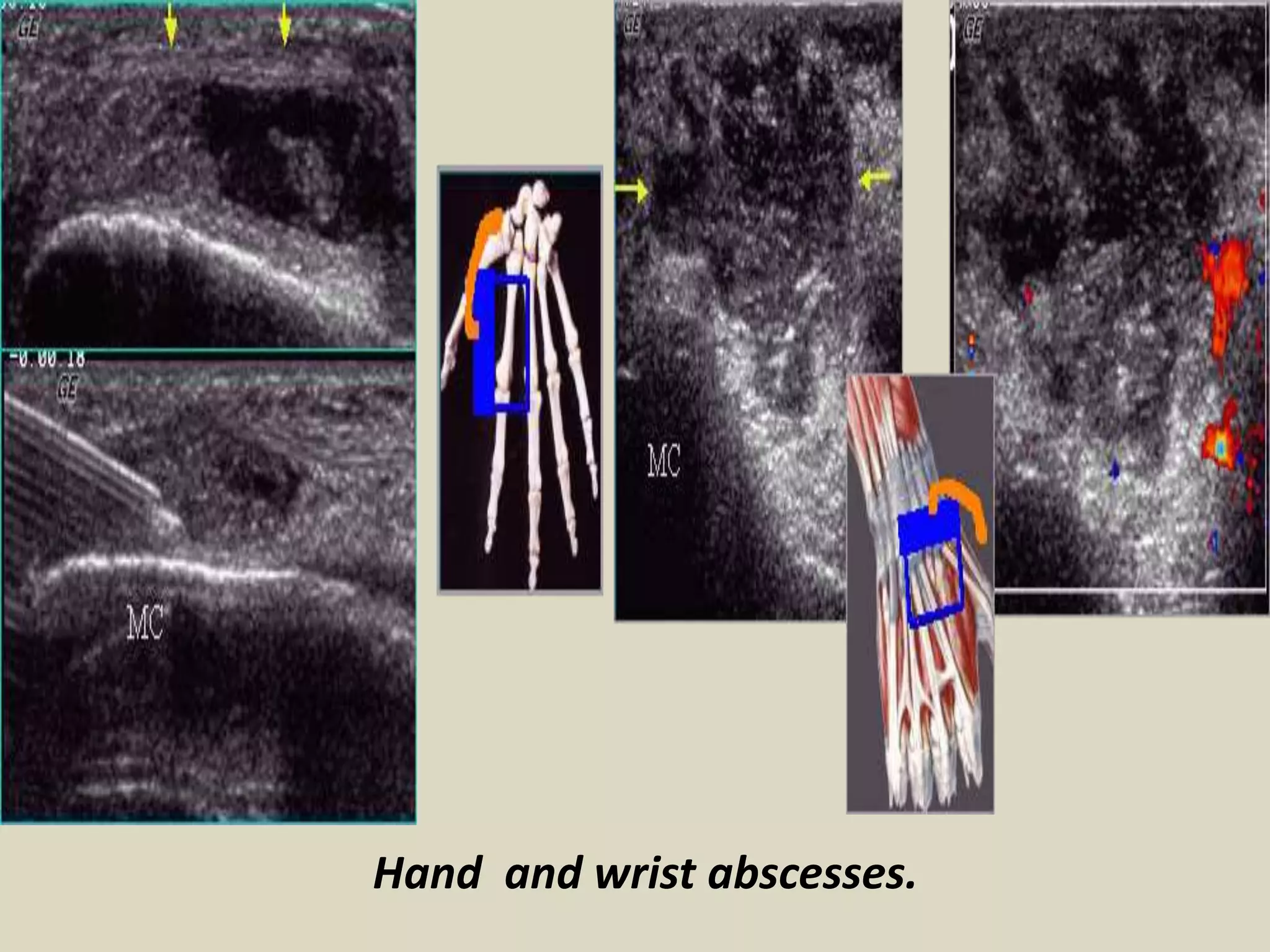 Presentation1.pptx, ultrasound examination of the wrist joint. | PPTX
