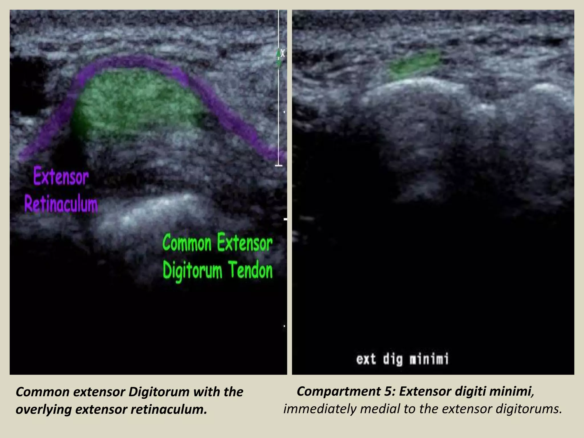 Presentation1.pptx, ultrasound examination of the wrist joint. | PPTX