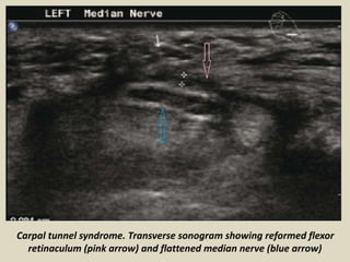 Presentation1.pptx, ultrasound examination of the wrist joint. | PPTX
