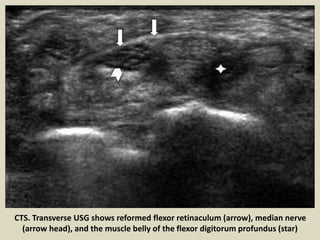 Presentation1.pptx, ultrasound examination of the wrist joint. | PPTX