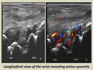 Presentation1.pptx, ultrasound examination of the wrist joint. | PPTX