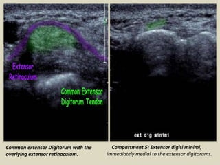 Presentation1.pptx, ultrasound examination of the wrist joint. | PPTX