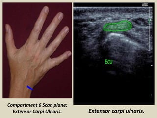 Presentation1.pptx, ultrasound examination of the wrist joint. | PPTX