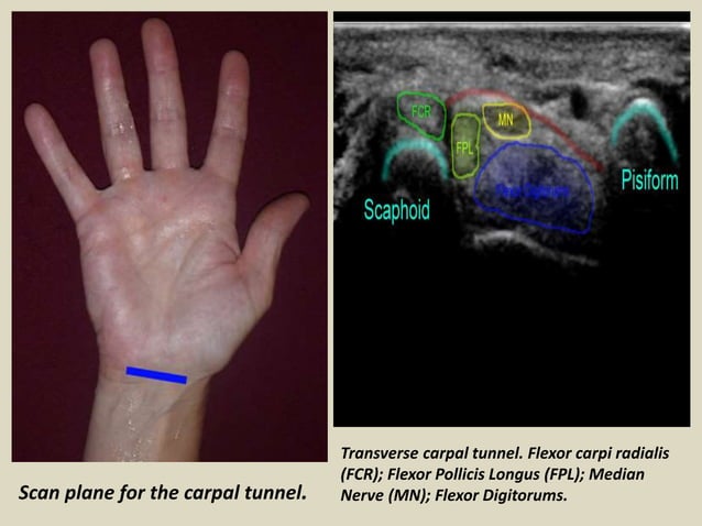 Presentation1pptx Ultrasound Examination Of The Wrist Joint Ppt