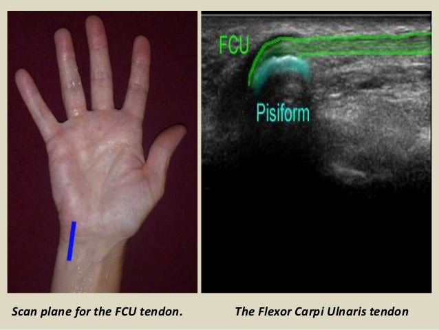 Presentation1pptx Ultrasound Examination Of The Wrist Joint