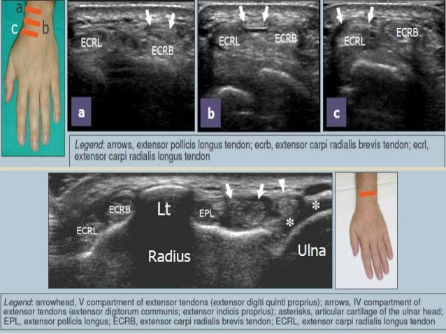 Flexor Tendons Wrist Ultrasound