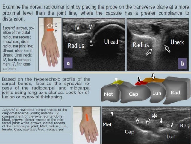 Presentation1pptx Ultrasound Examination Of The Wrist Joint