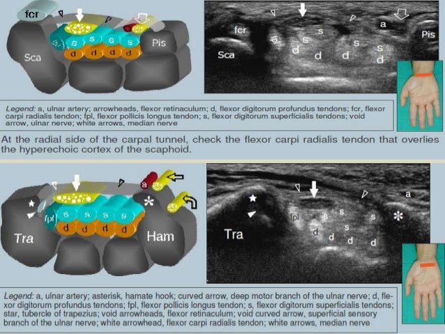 Presentation1.pptx, ultrasound examination of the wrist joint.