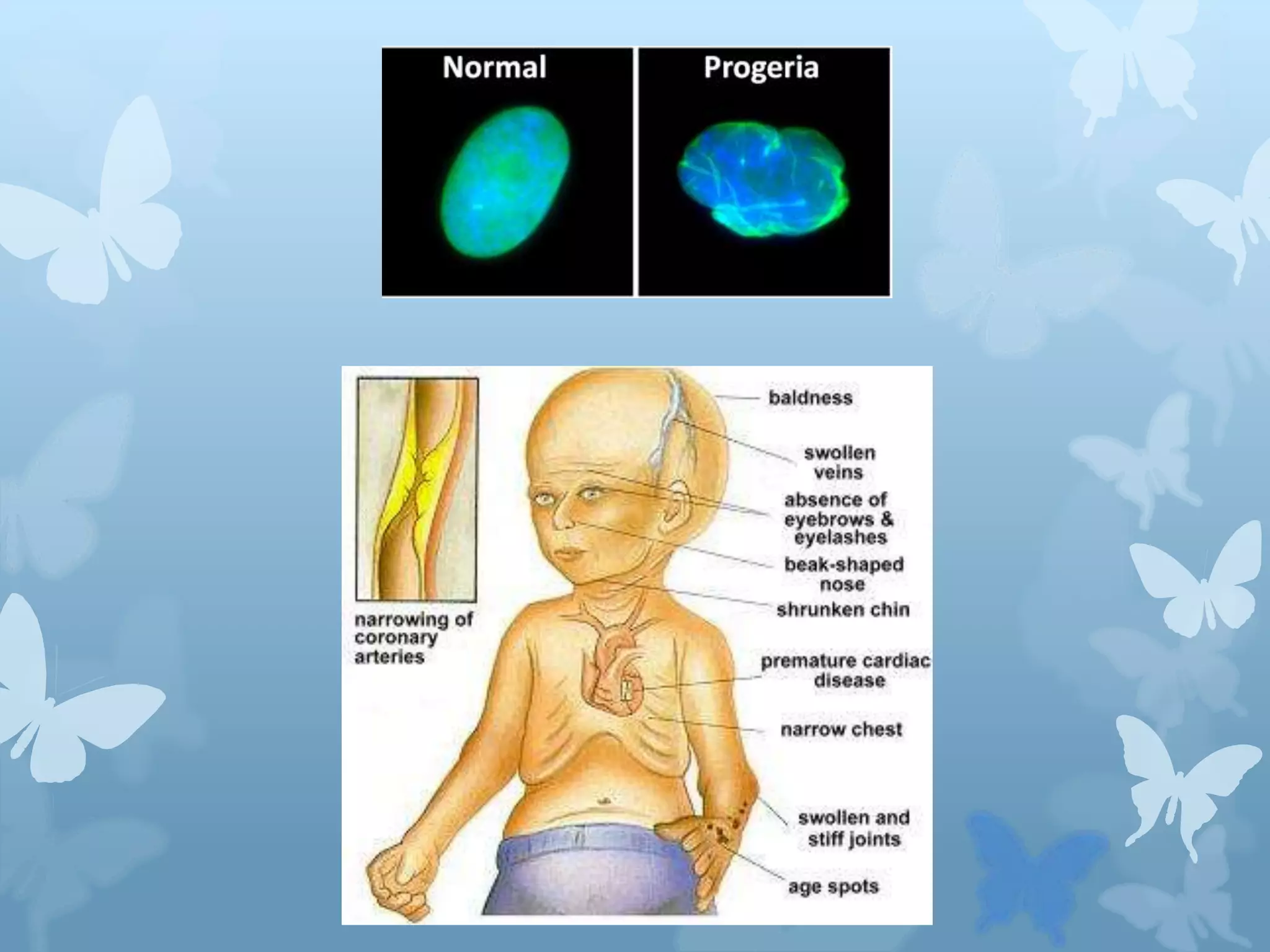 Progeria Syndrome | PPTX
