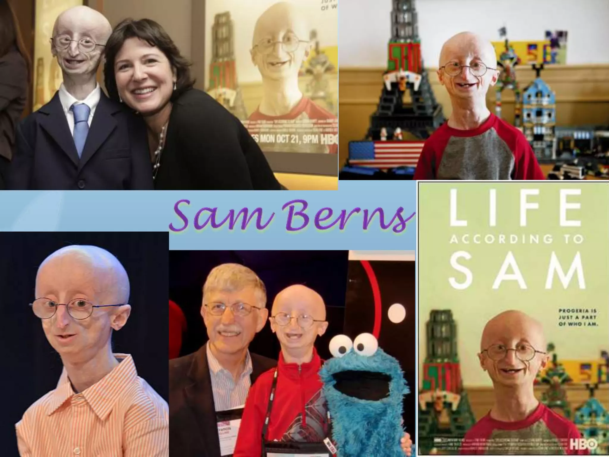 Progeria Syndrome | PPTX