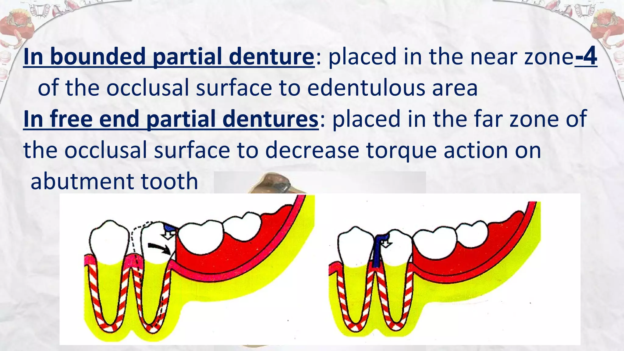 Rest and Rest Seat preparation..removable partial denture | PPT