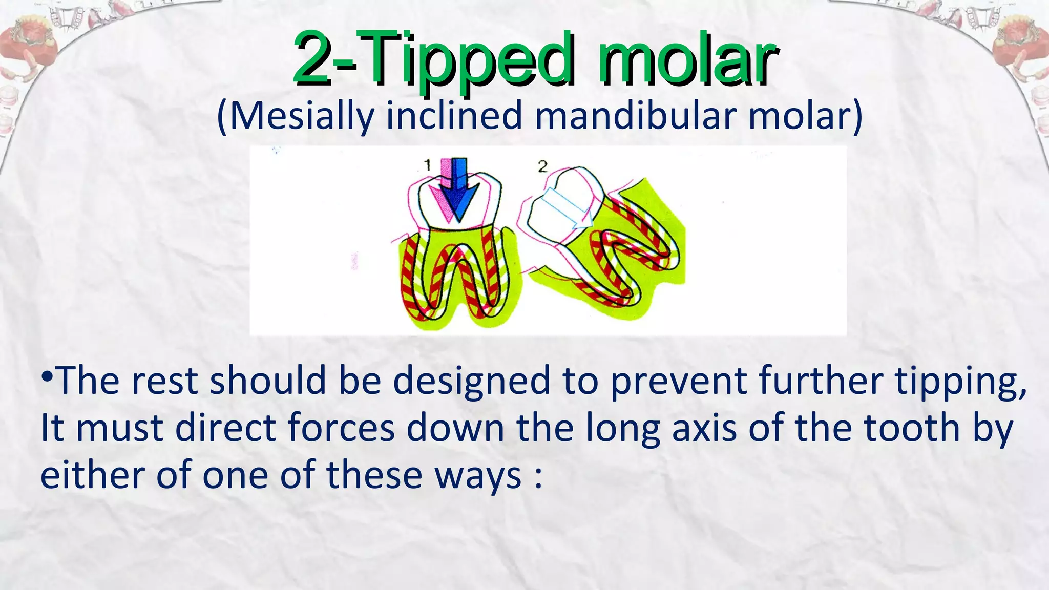 Rest and Rest Seat preparation..removable partial denture | PPT