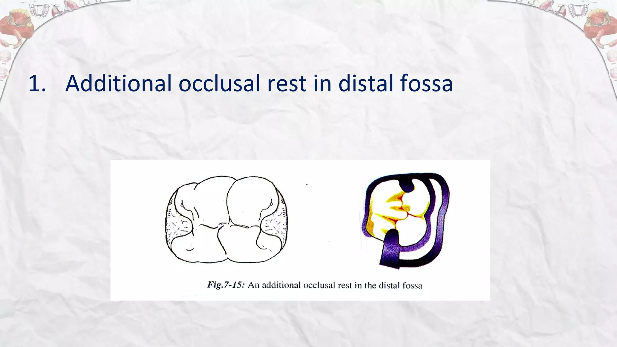 Rest and Rest Seat preparation..removable partial denture | PPT