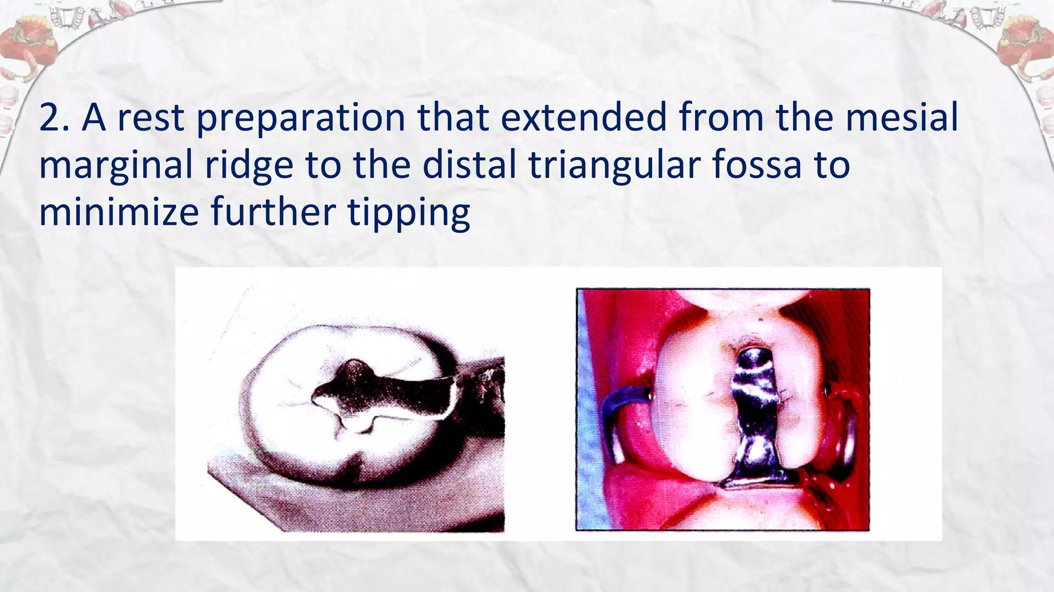Rest and Rest Seat preparation..removable partial denture | PPT