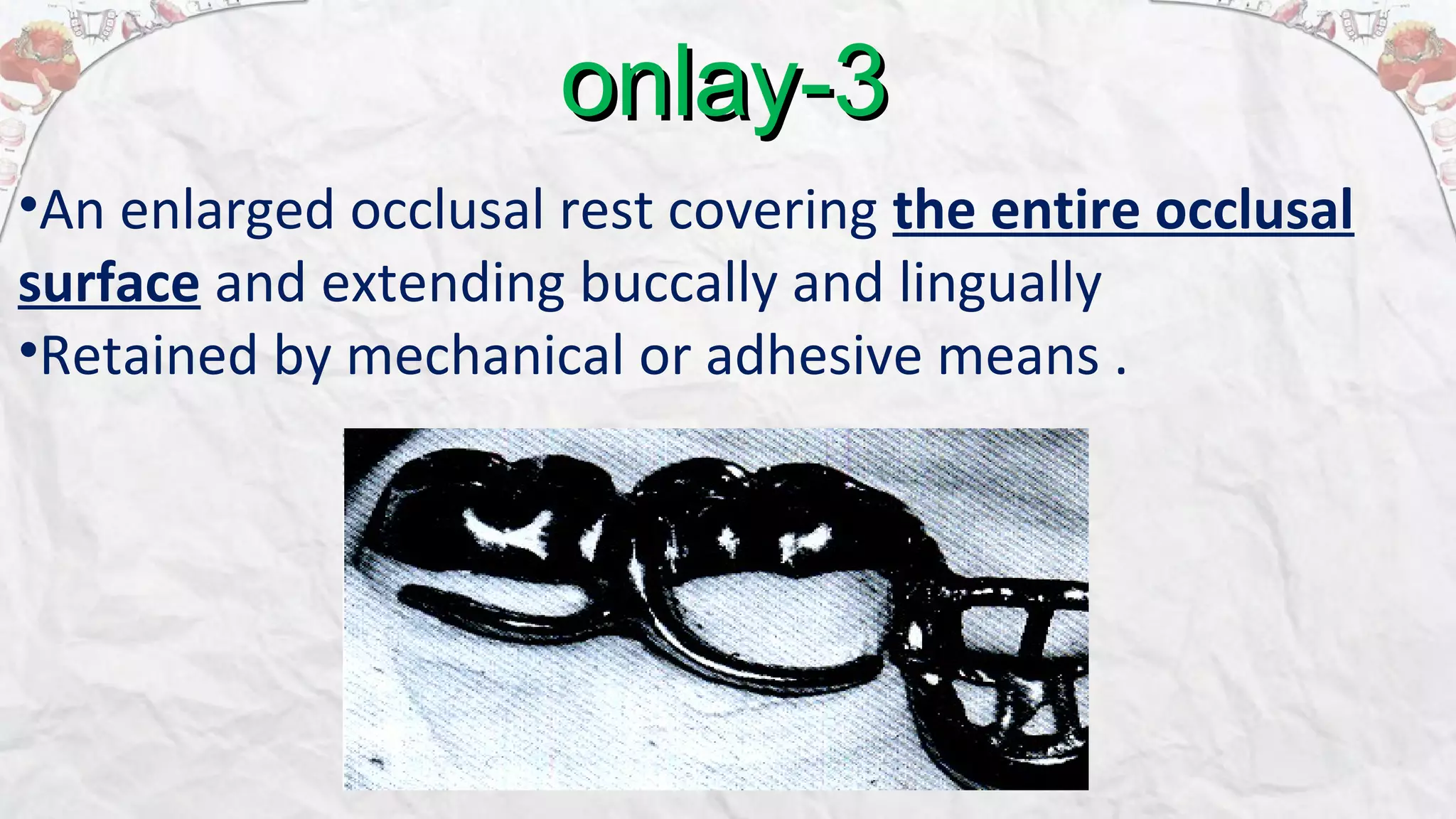 Rest and Rest Seat preparation..removable partial denture | PPT