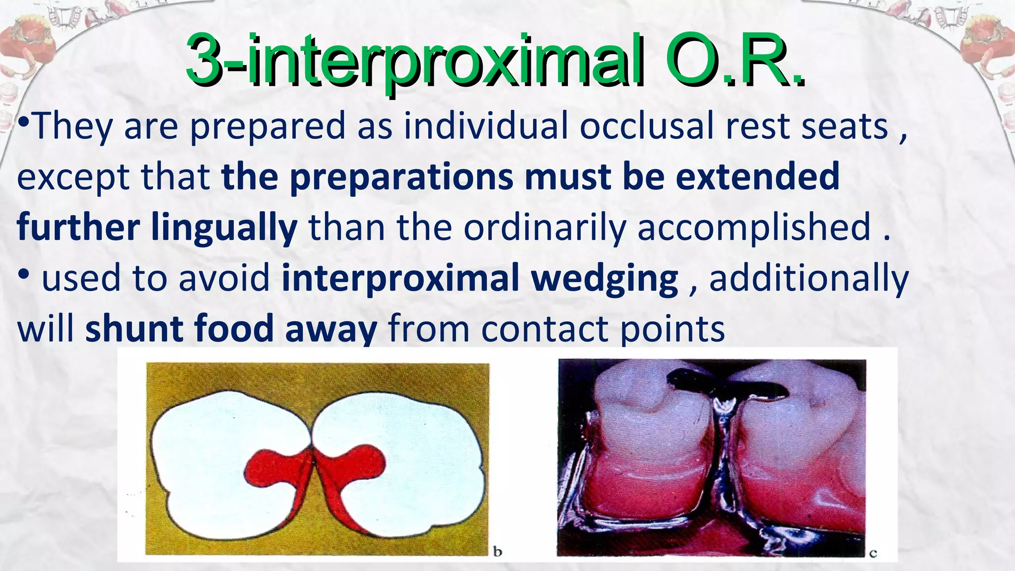 Rest and Rest Seat preparation..removable partial denture | PPT
