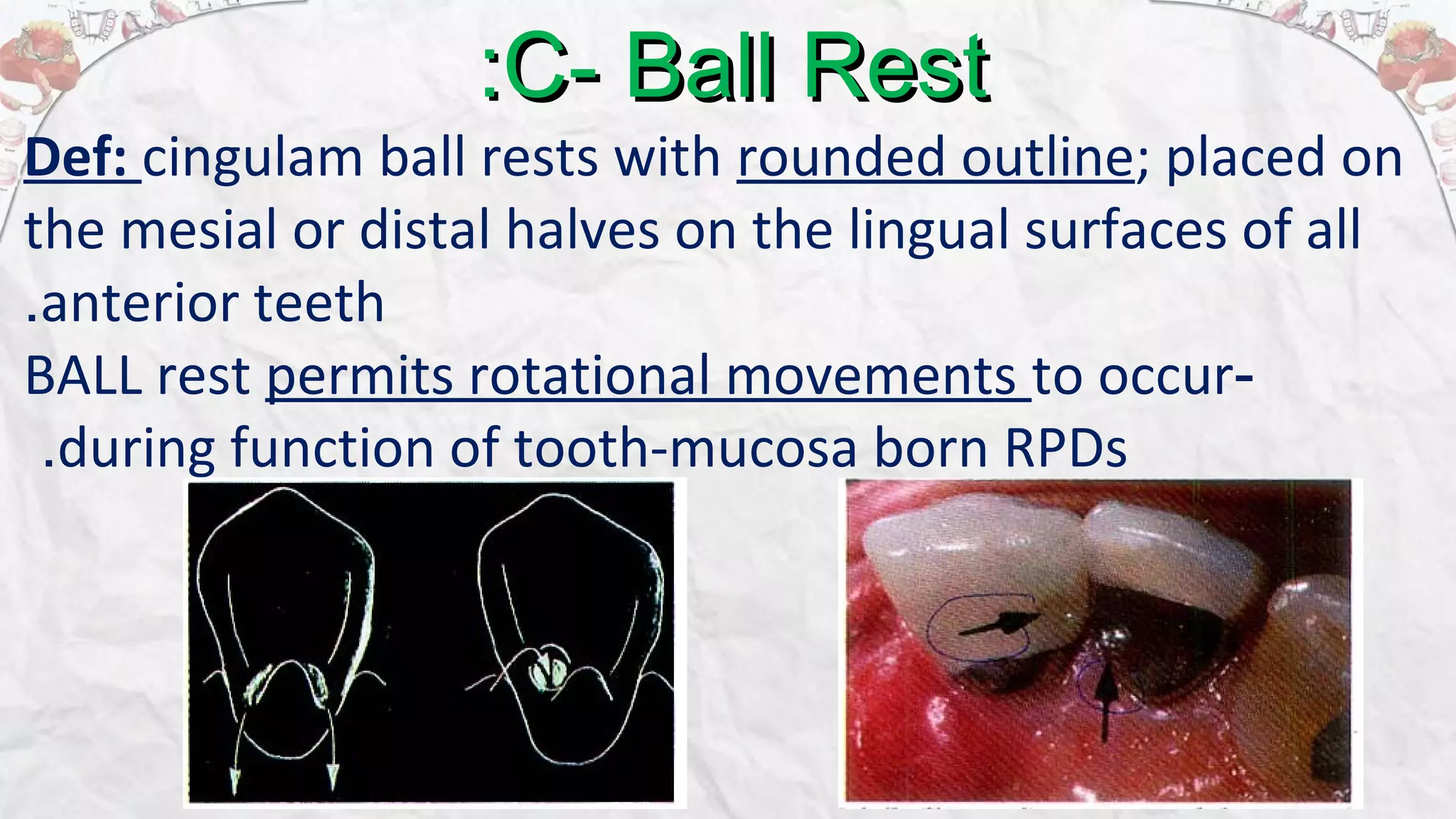 Rest and Rest Seat preparation..removable partial denture | PPT ...