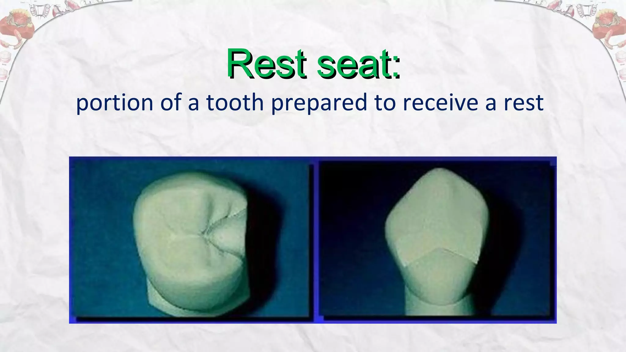 Rest and Rest Seat preparation..removable partial denture | PPT