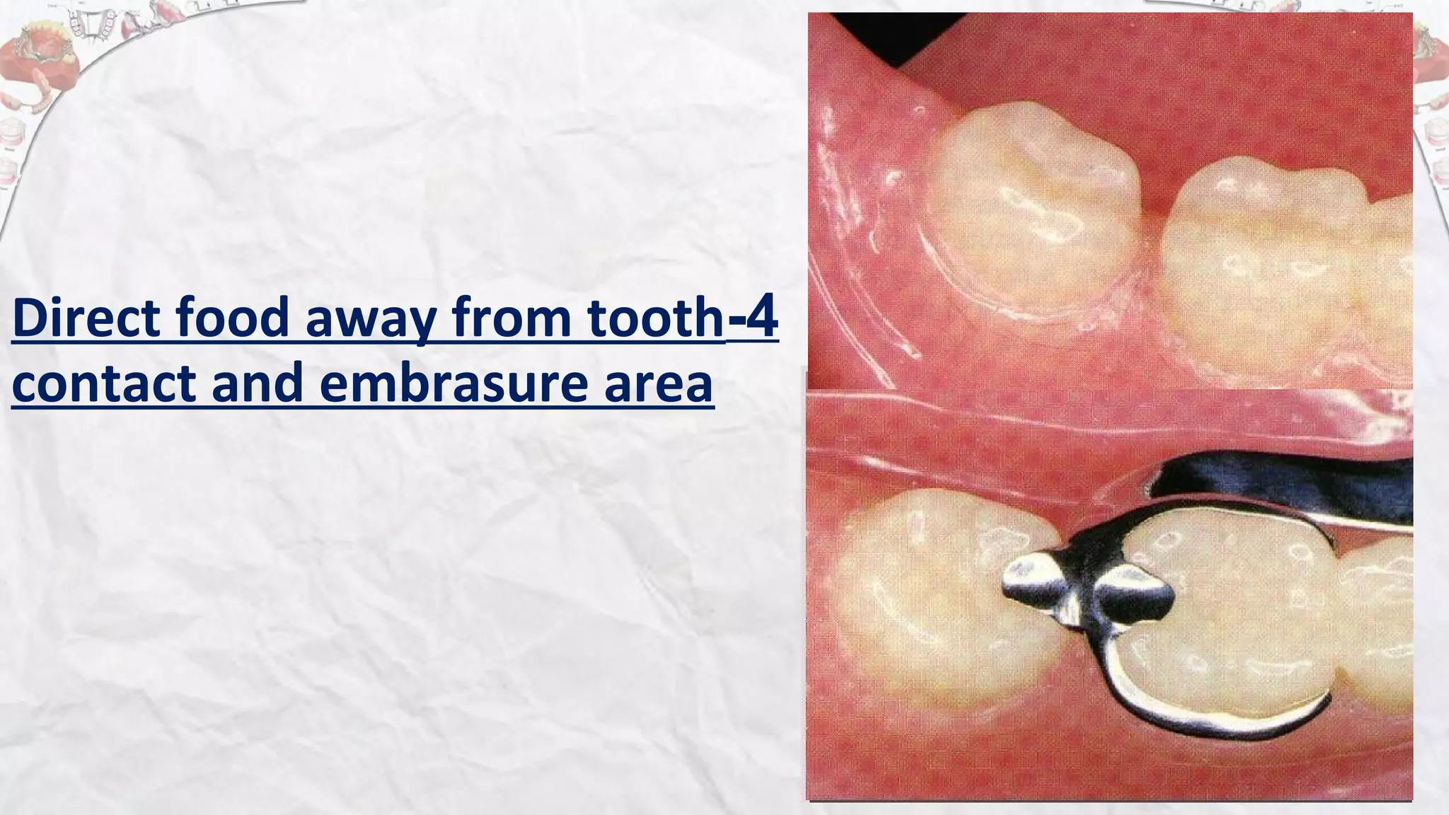 Rest and Rest Seat preparation..removable partial denture | PPT