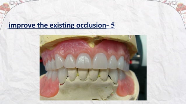 Rest and Rest Seat preparation..removable partial denture | PPT ...