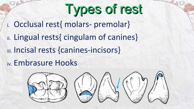 Rest and Rest Seat preparation..removable partial denture | PPT ...