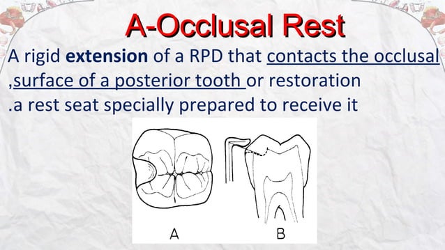 Rest and Rest Seat preparation..removable partial denture | PPT ...