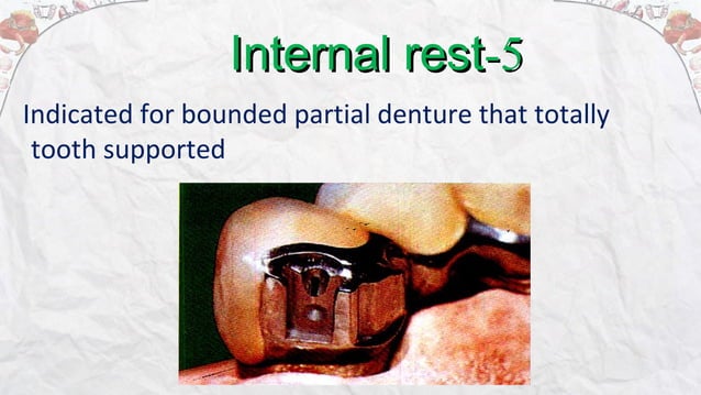 Rest and Rest Seat preparation..removable partial denture | PPT ...